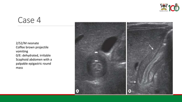 neonatal Intestinal obstruction; etiology, diagnosis and management.pptx