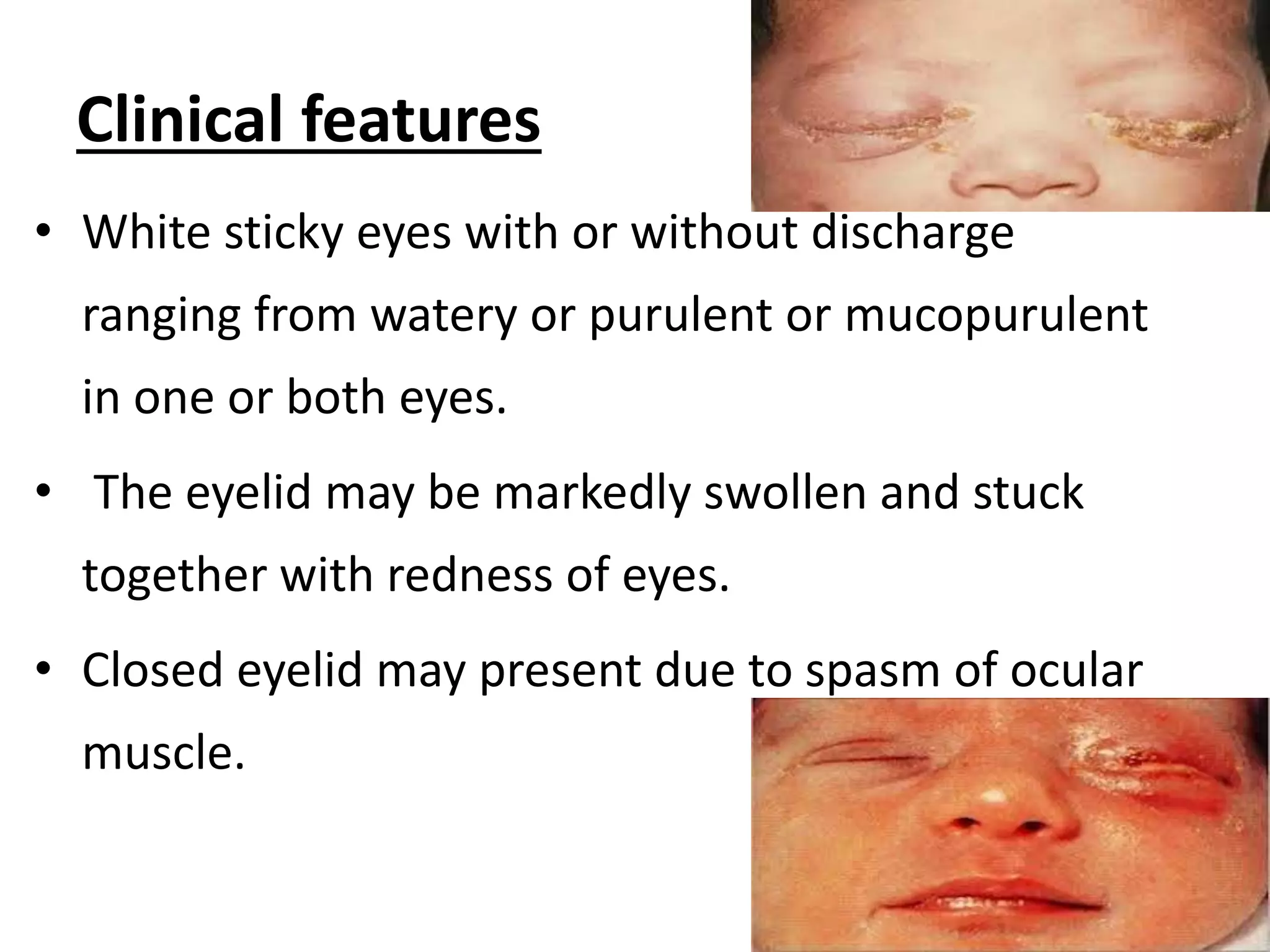 Neonatal infections | PPTX