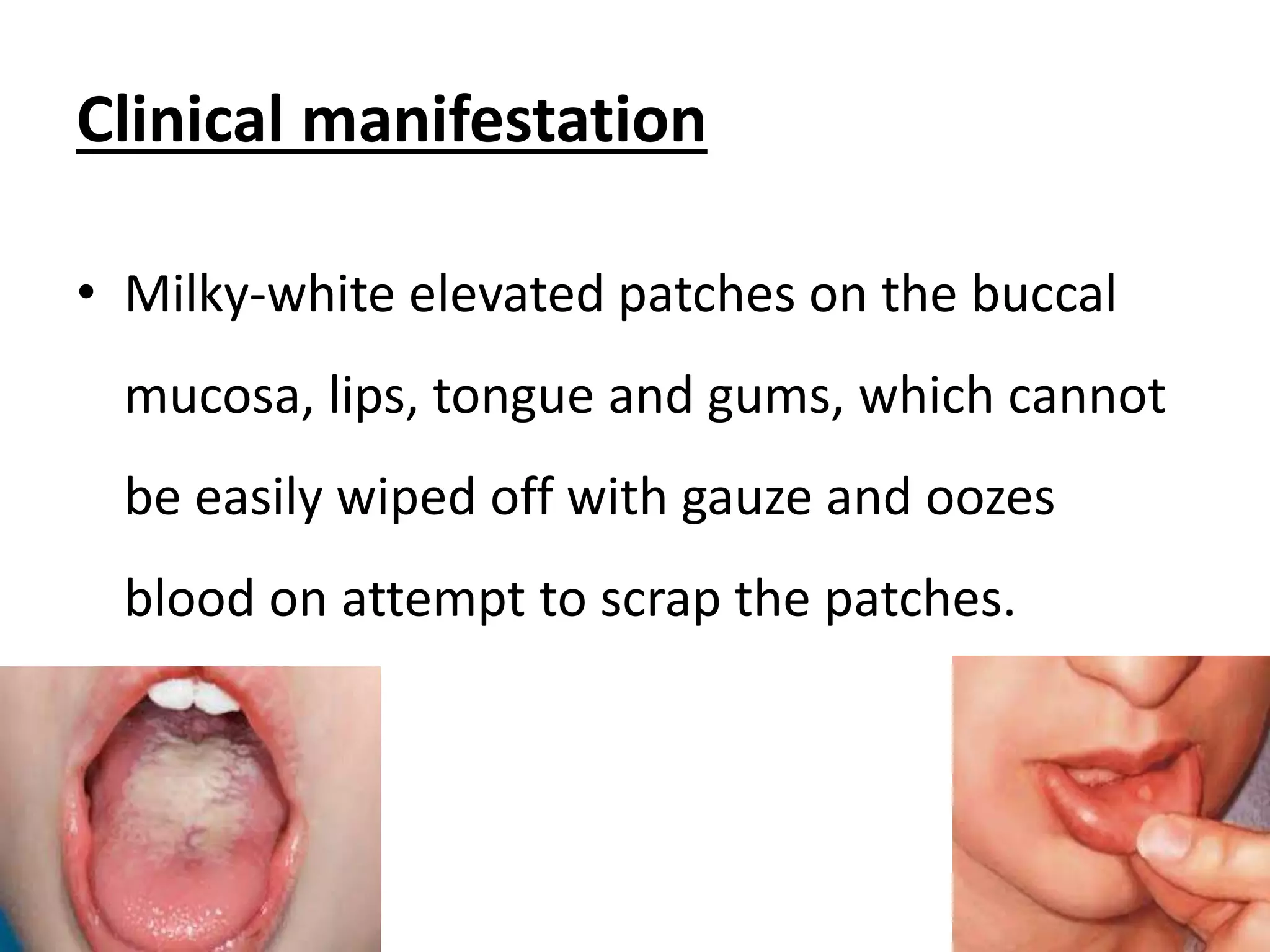 Neonatal infections | PPTX