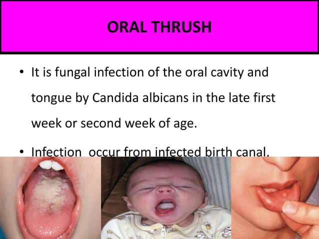 Neonatal infections | PPTX | Pregnancy | Reproductive Health