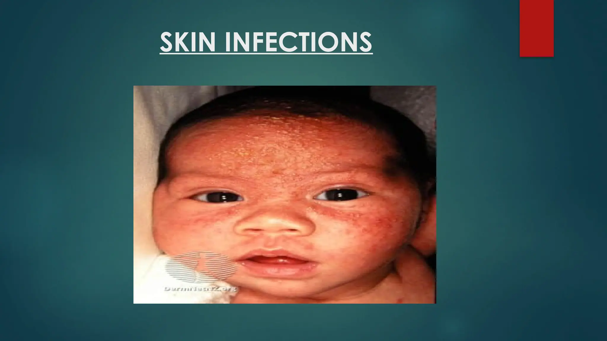 neonatal infections/infections in newborn.pptx
