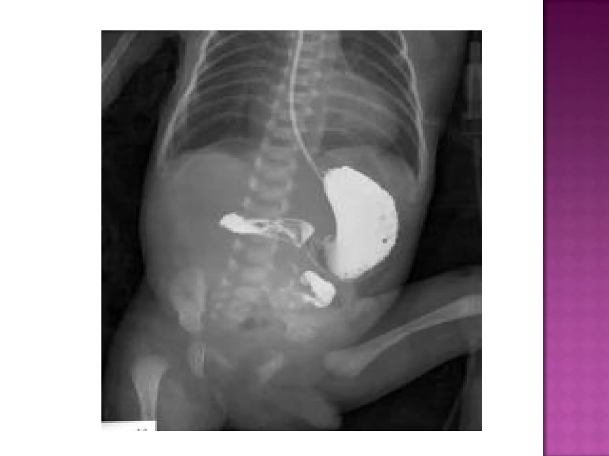 Neonatal intestinal obstruction | PPT