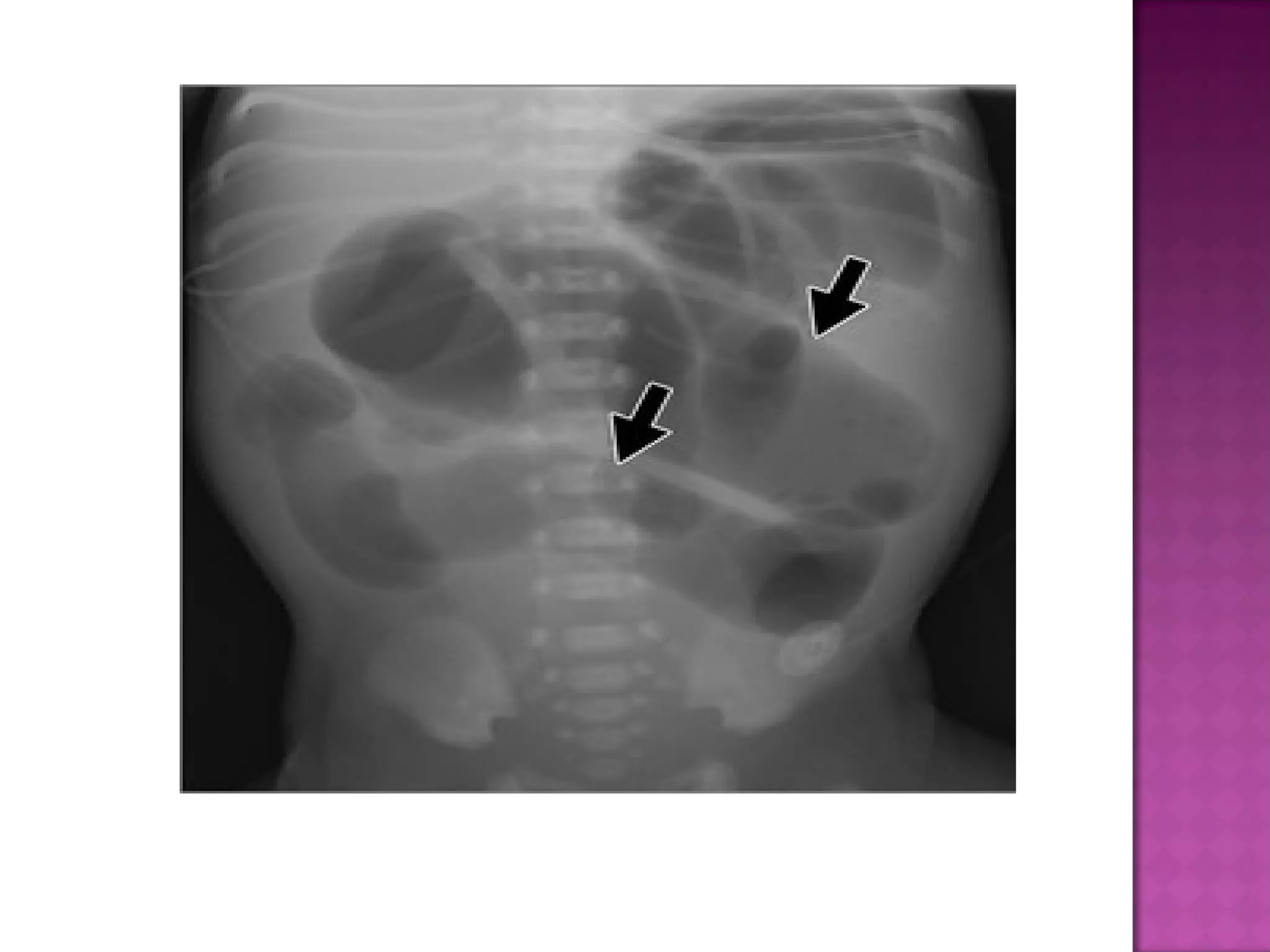 Neonatal intestinal obstruction | PPT