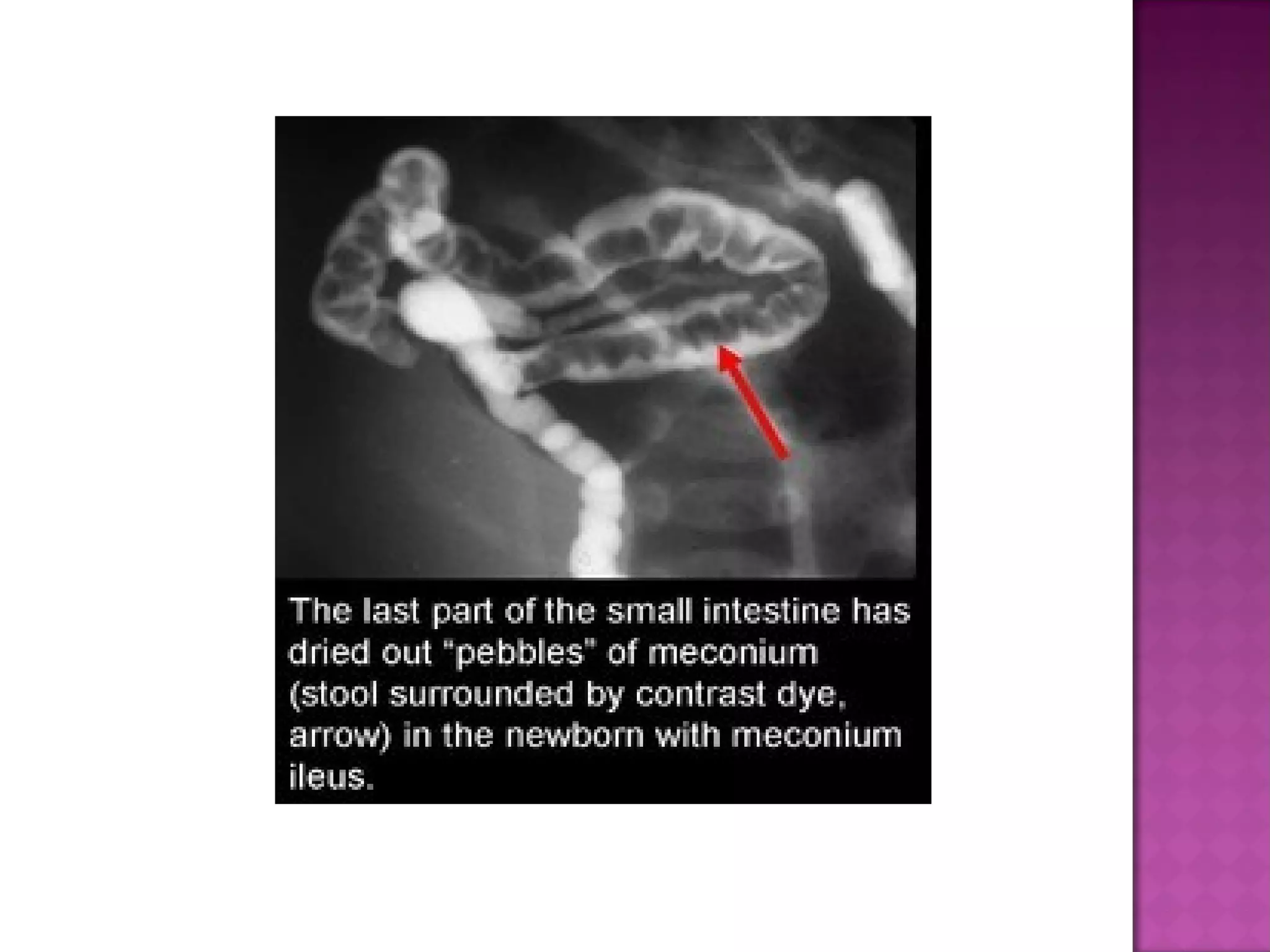 Neonatal intestinal obstruction | PPT