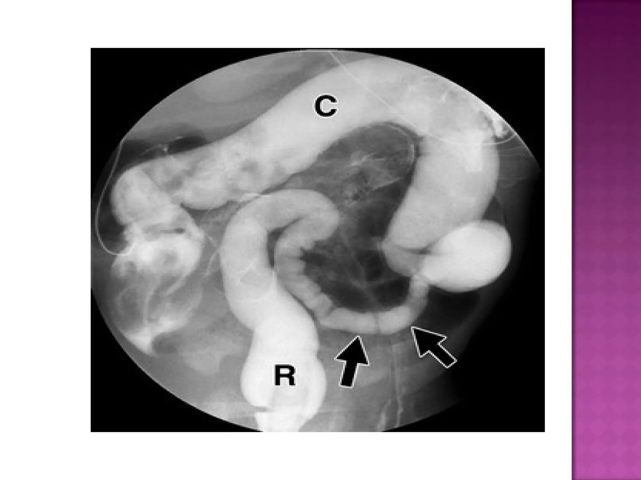 Neonatal intestinal obstruction | PPT