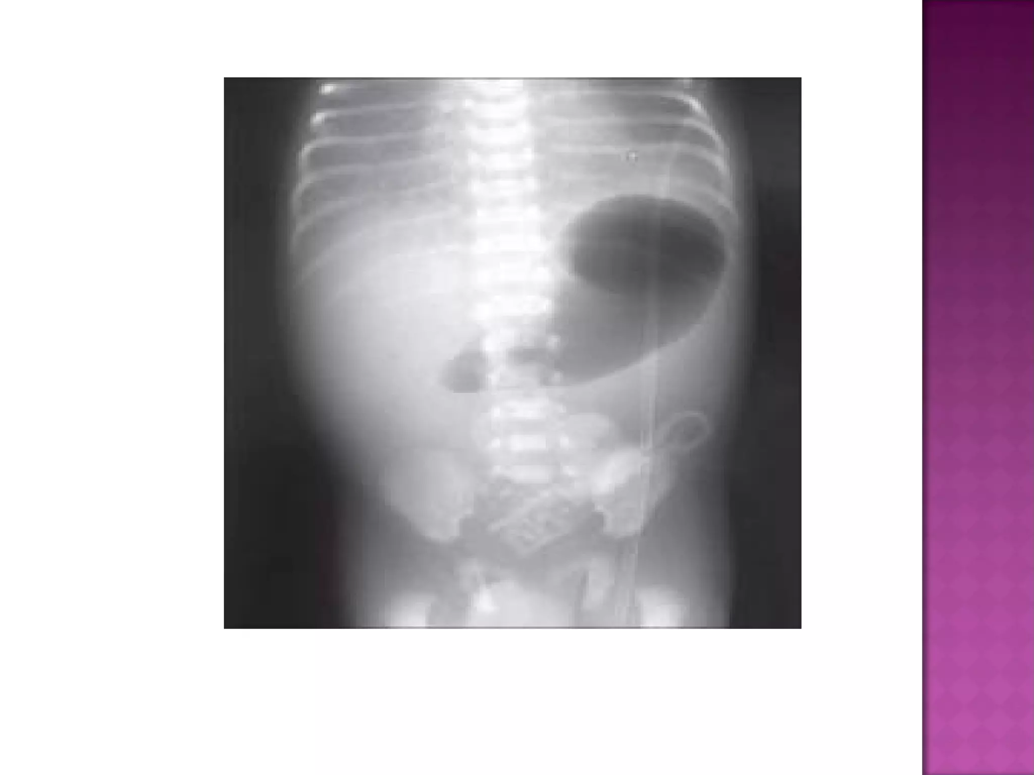 Neonatal intestinal obstruction | PPT