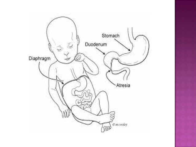 Neonatal intestinal obstruction | PPT