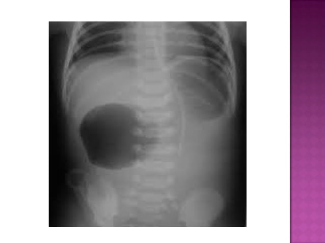 Neonatal intestinal obstruction | PPT