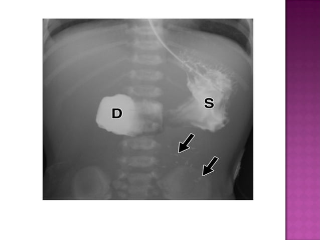 Neonatal intestinal obstruction | PPT