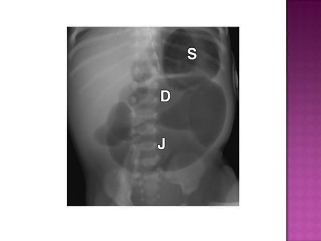 Neonatal intestinal obstruction | PPT