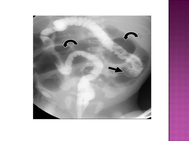 Neonatal intestinal obstruction | PPT