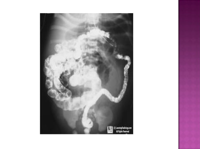 Neonatal intestinal obstruction | PPT