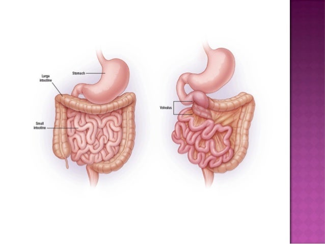 Neonatal intestinal obstruction