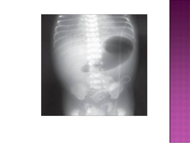 Neonatal intestinal obstruction