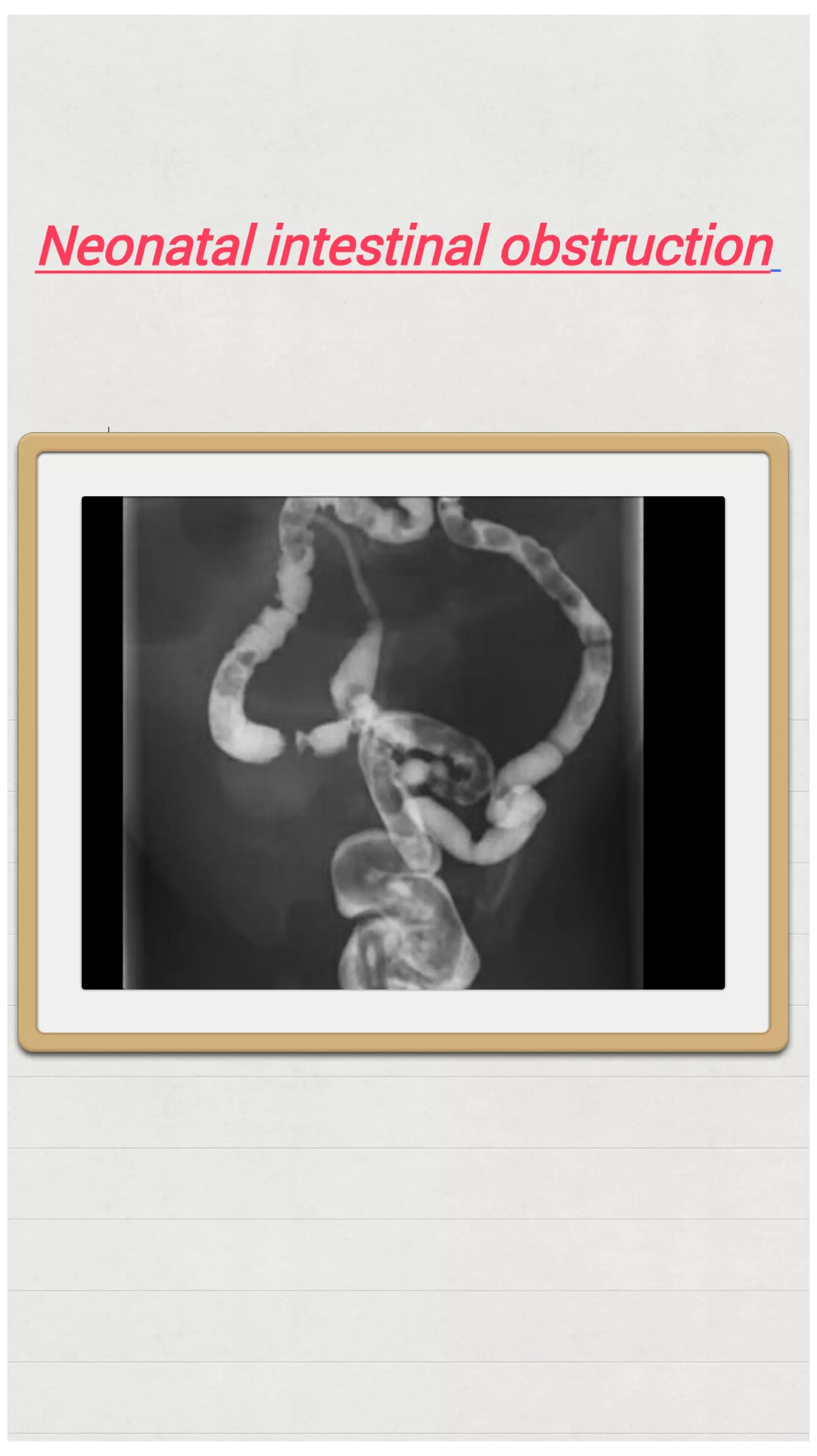 Neonatal intestinal obstruction | PDF