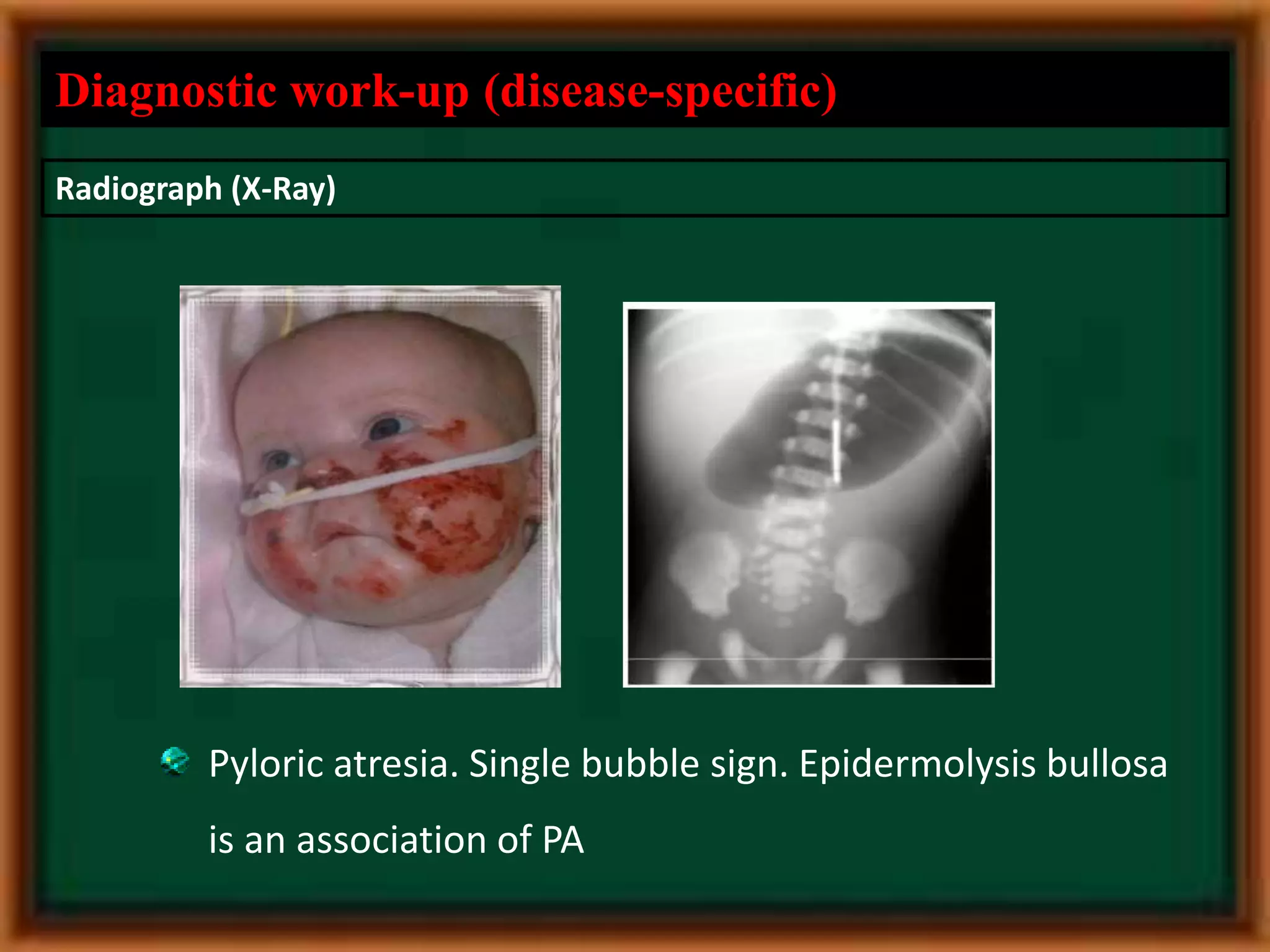 Neonatal intestinal obstruction | PPTX