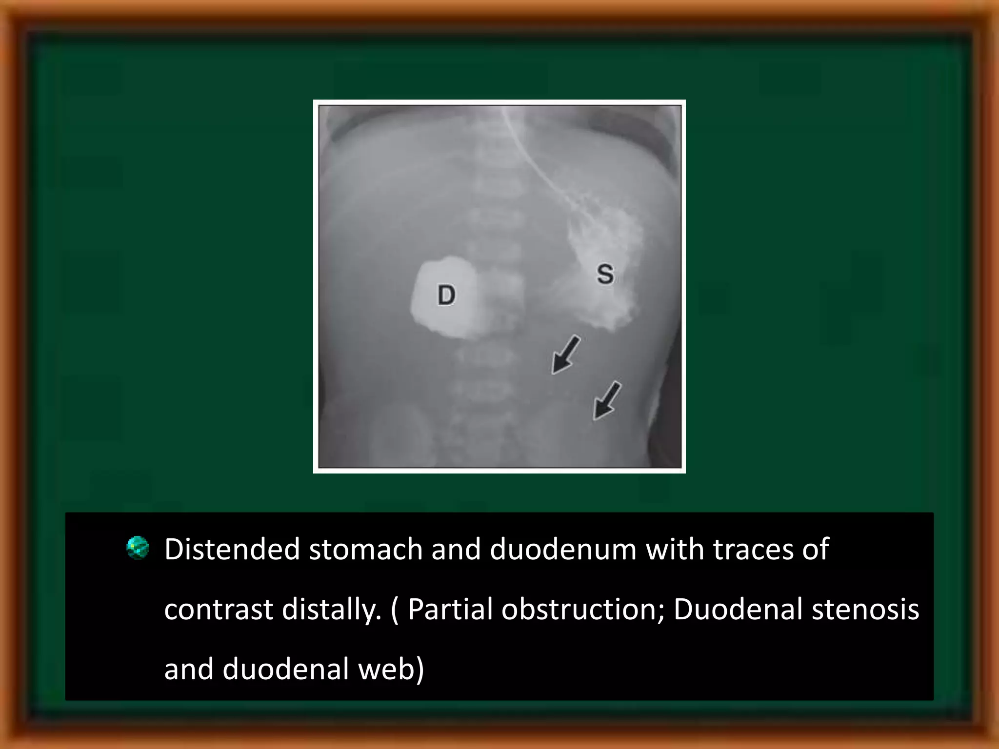 Neonatal intestinal obstruction | PPTX