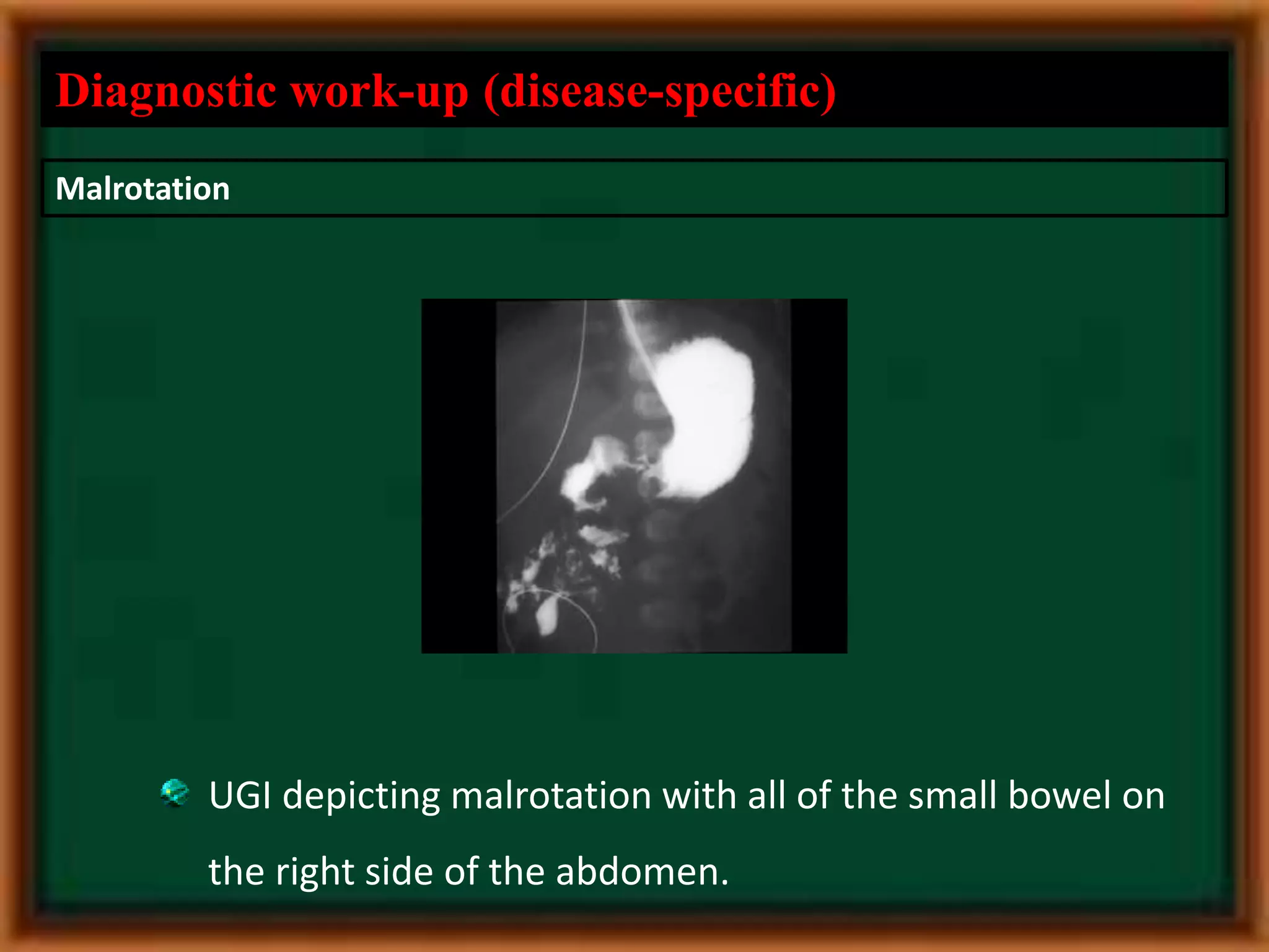 Neonatal intestinal obstruction | PPTX