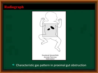 Neonatal intestinal obstruction | PPTX