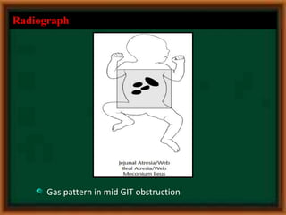 Neonatal intestinal obstruction | PPTX
