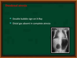 Neonatal intestinal obstruction | PPTX