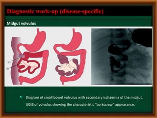 Neonatal intestinal obstruction | PPTX