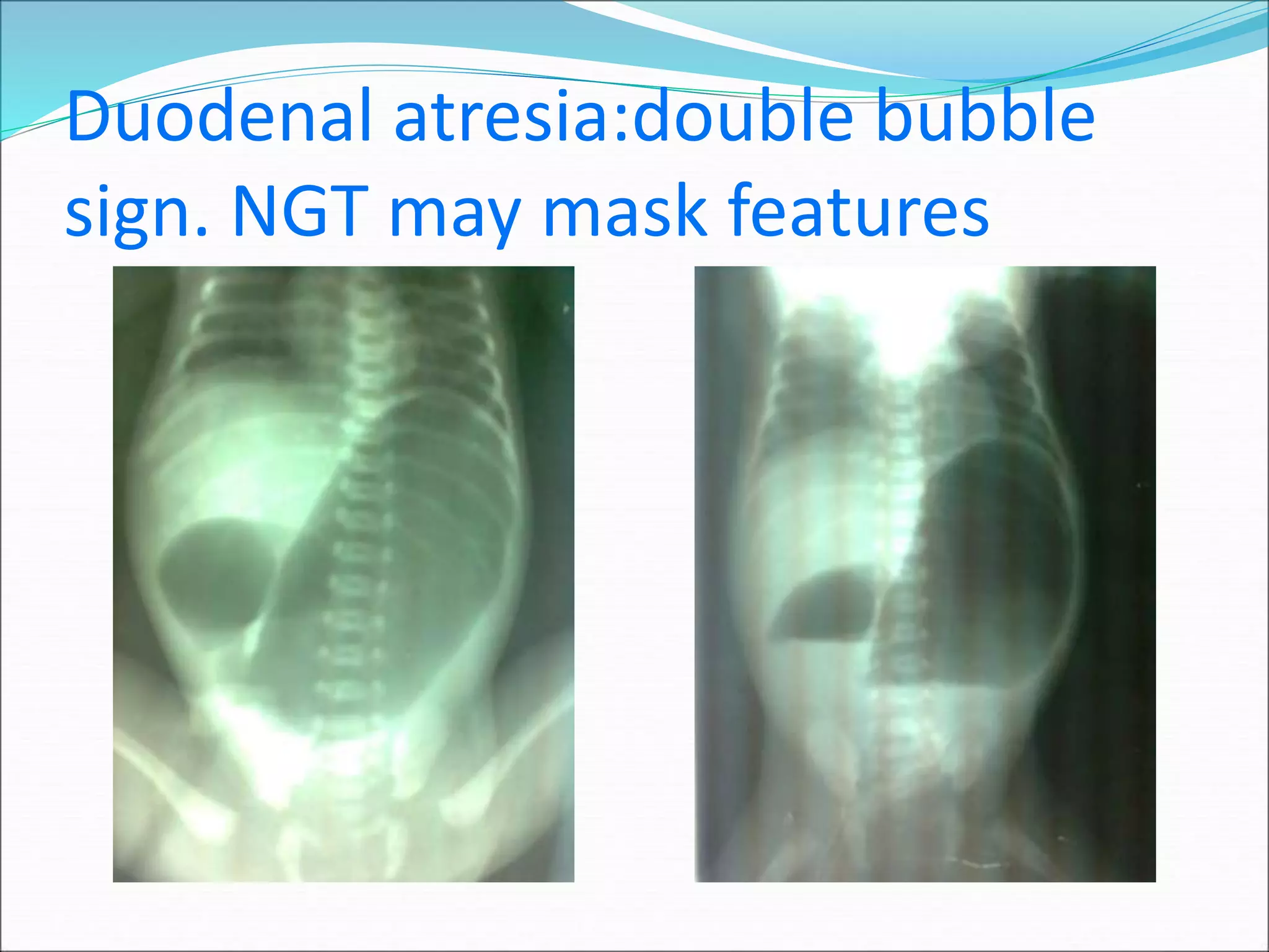neonatal intestinal obstruction.ppt