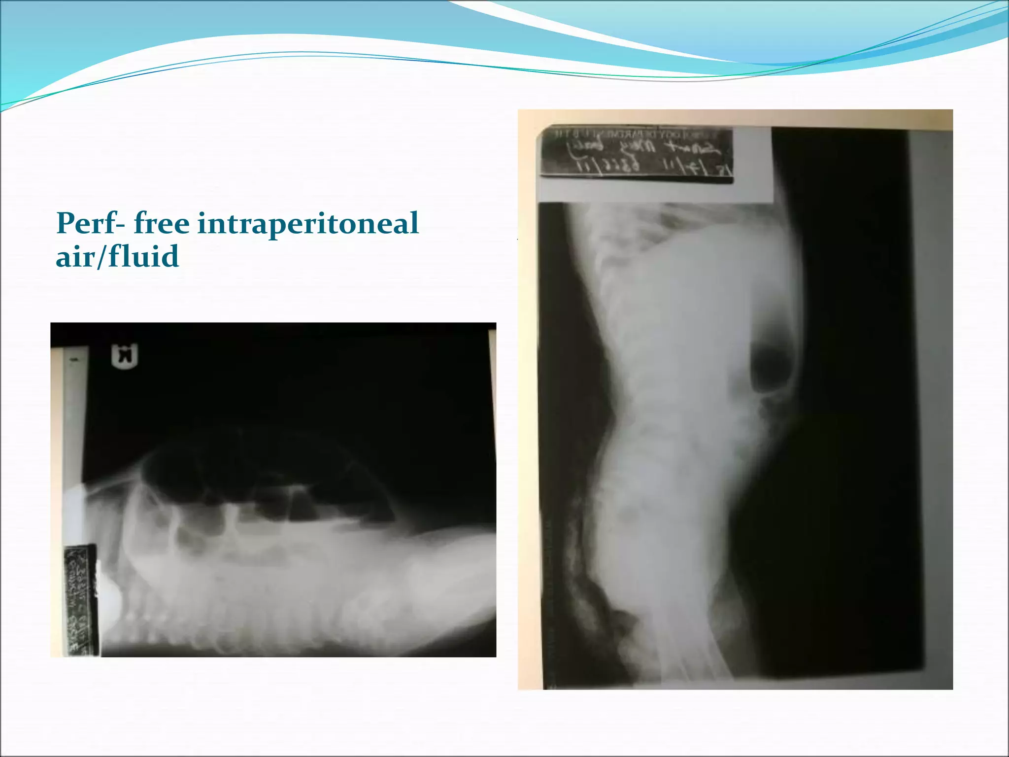neonatal intestinal obstruction.ppt