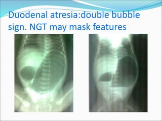 neonatal intestinal obstruction.ppt