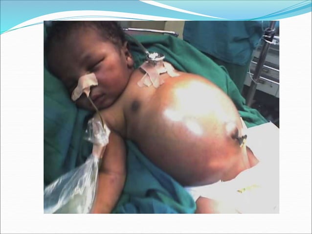 neonatal intestinal obstruction.ppt