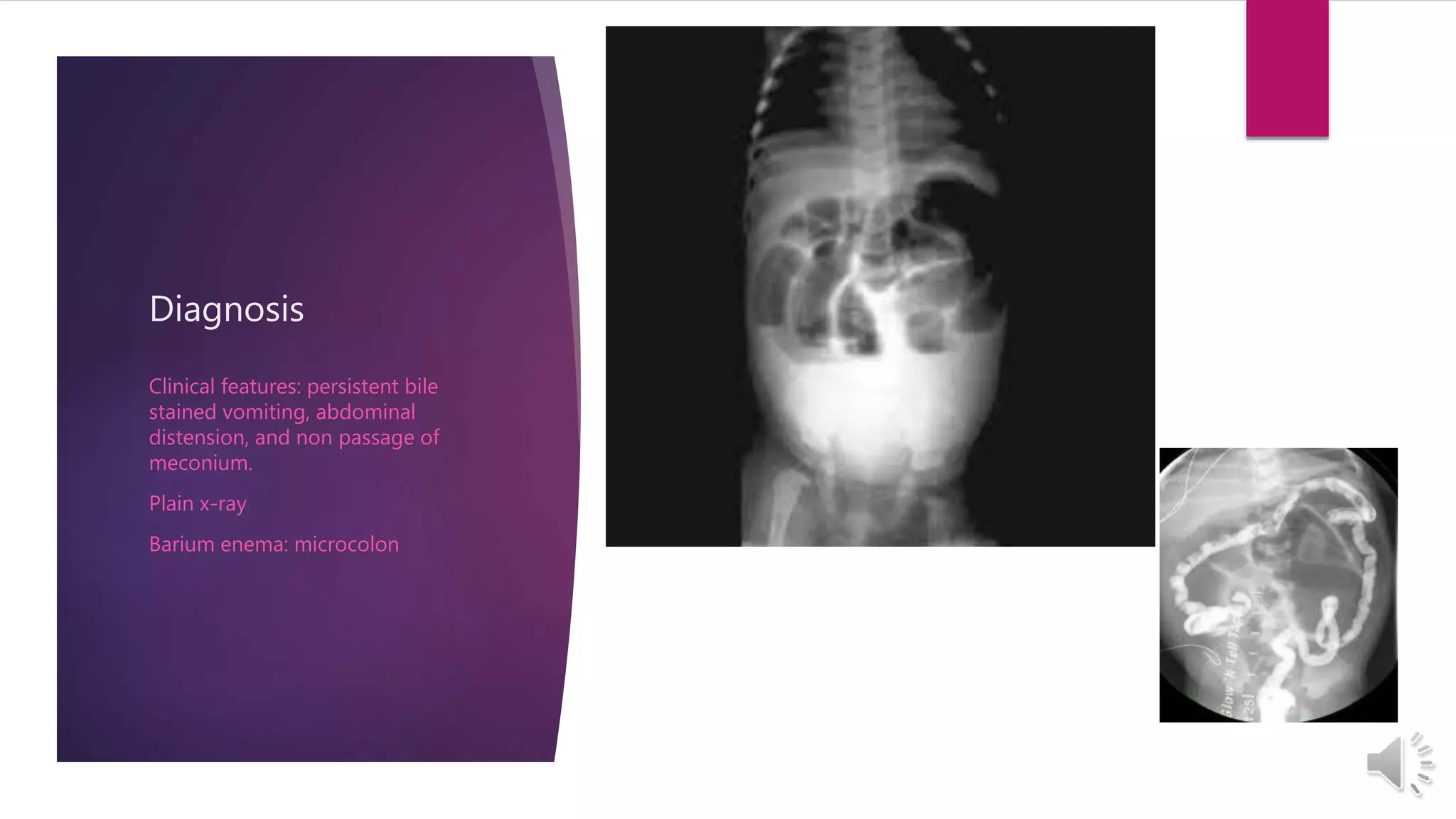 Neonatal intestinal obstruction ppt 6 th year | PPTX