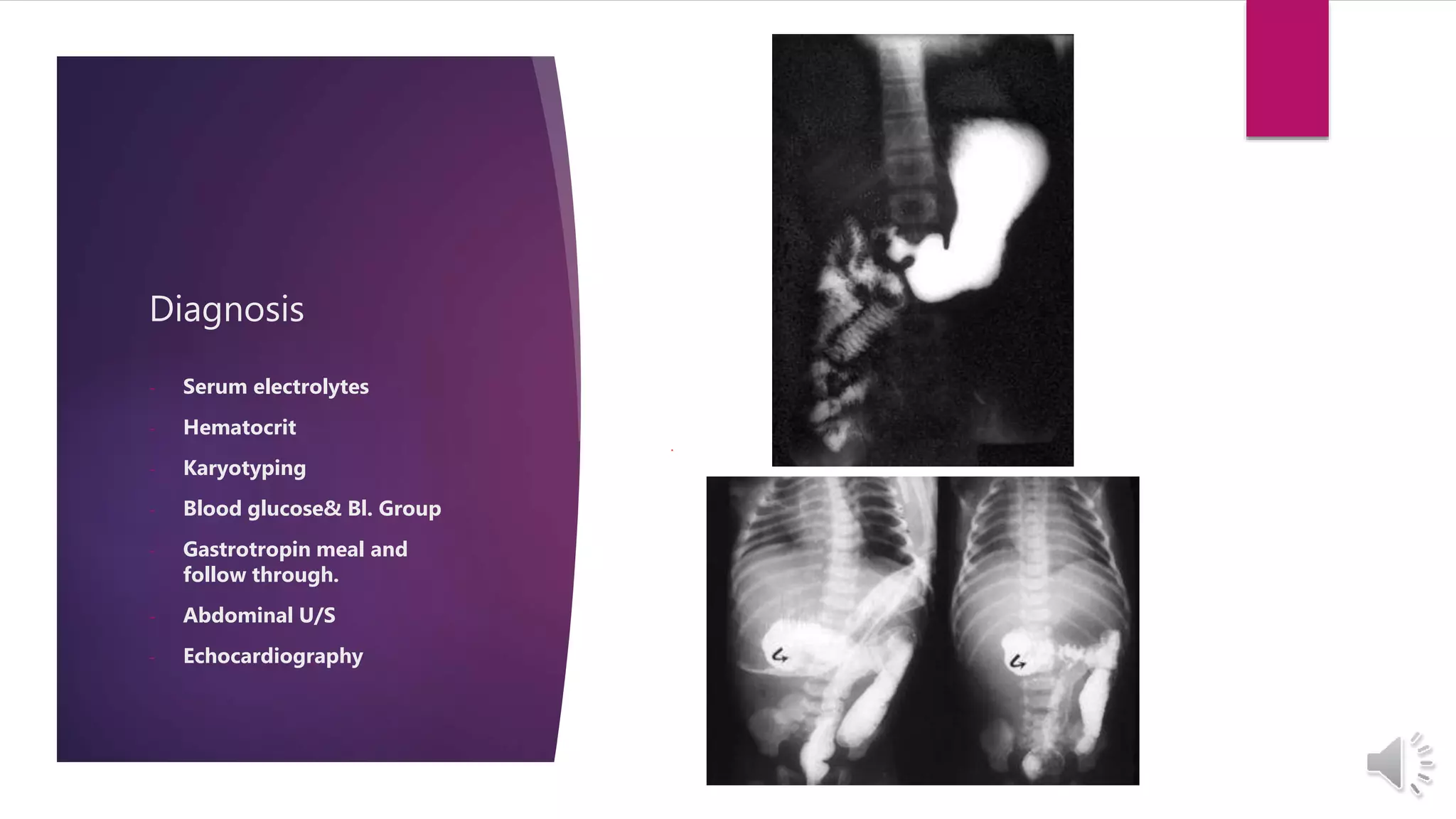 Neonatal intestinal obstruction ppt 6 th year | PPTX