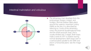 Neonatal intestinal obstruction ppt 6 th year | PPTX