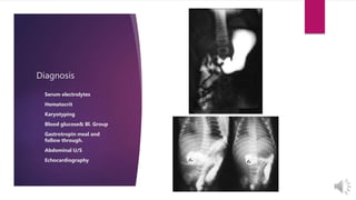 Neonatal intestinal obstruction ppt 6 th year | PPTX