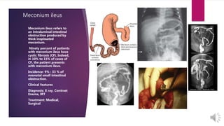 Neonatal intestinal obstruction ppt 6 th year | PPTX