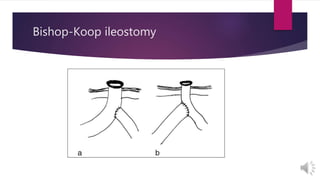 Neonatal intestinal obstruction ppt 6 th year | PPTX