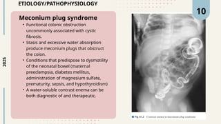 NEONATAL IO.pptx surgical paediatric emergencies | PPT