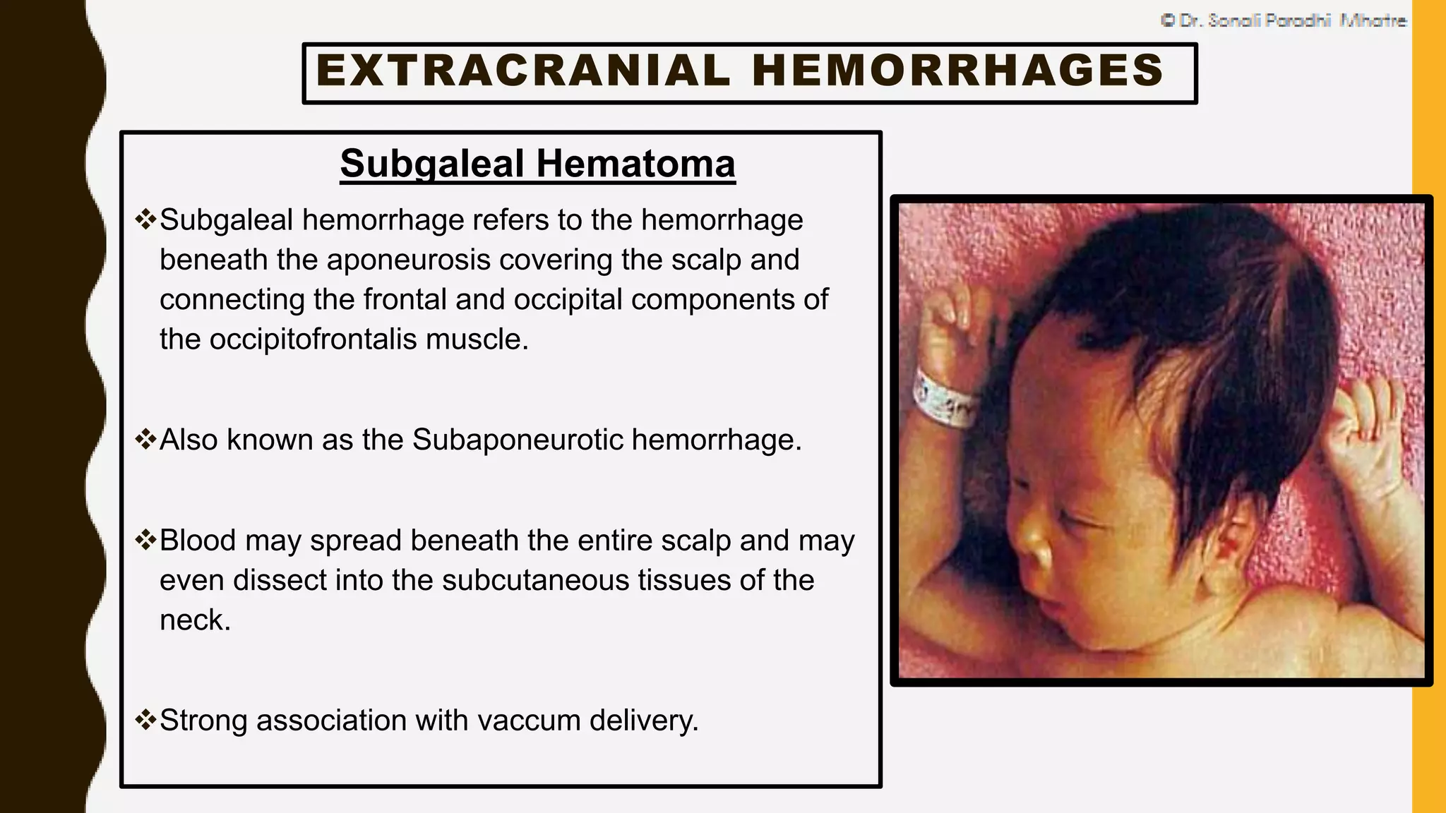 Neonatal Intracranial Hemorrhage - by dr. Sonali Mhatre | PPTX