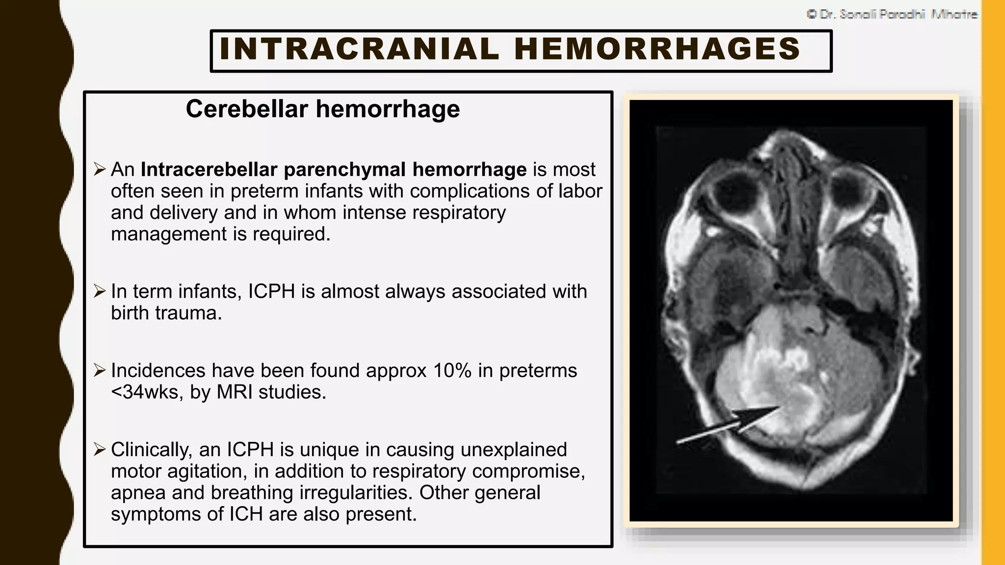 Neonatal Intracranial Hemorrhage - by dr. Sonali Mhatre | PPTX