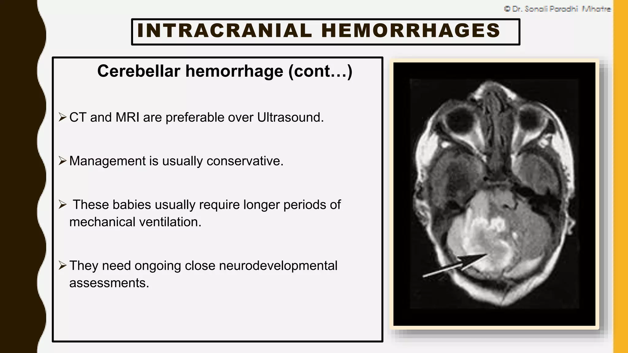 Neonatal Intracranial Hemorrhage - by dr. Sonali Mhatre | PPTX