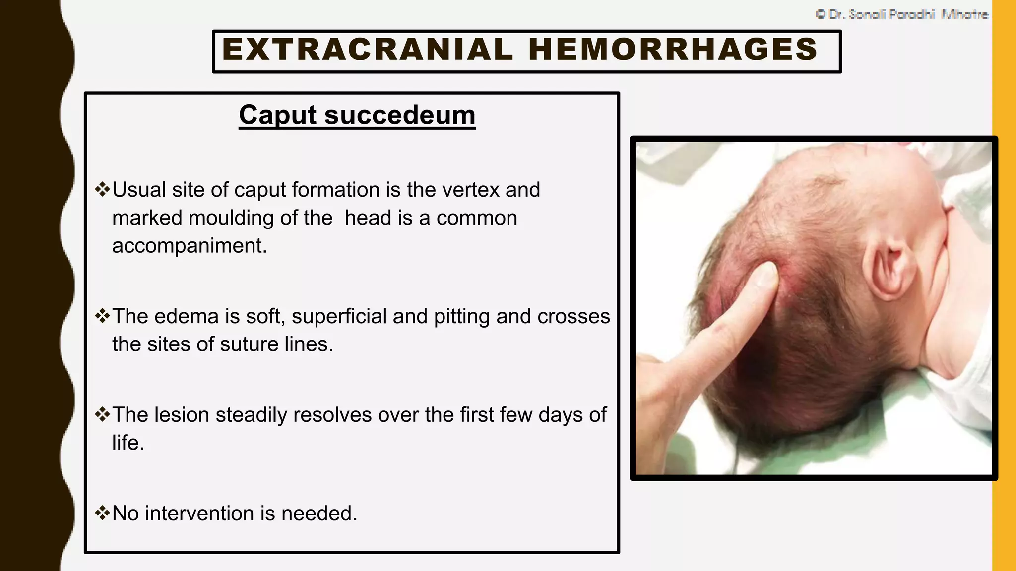 Neonatal Intracranial Hemorrhage - by dr. Sonali Mhatre | PPTX