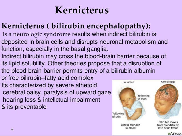 Neonatal jaundice