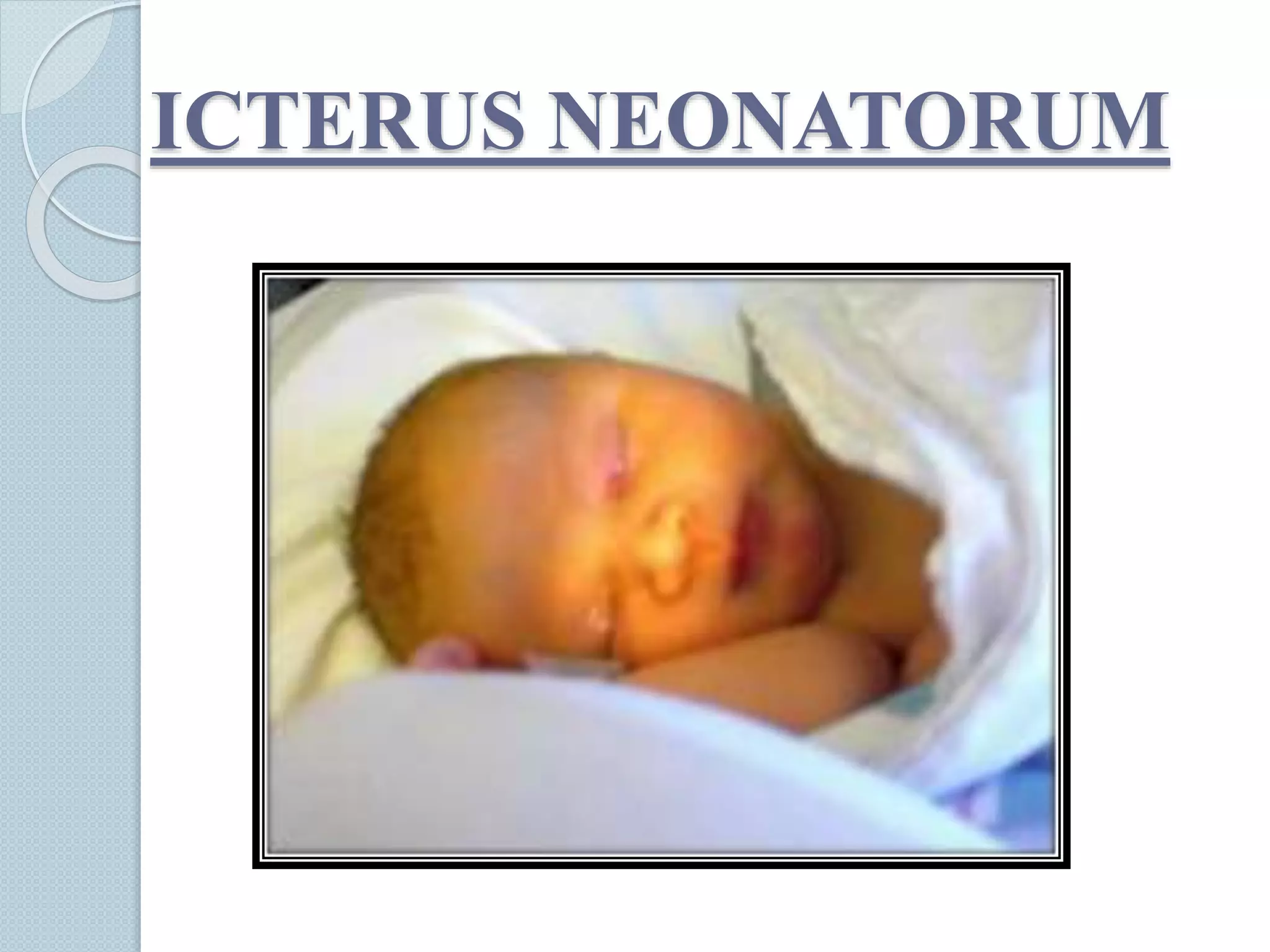 Physiological jaundice among newborns/ Icterus neonatorum | PPTX