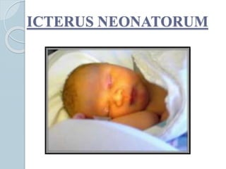 Physiological jaundice among newborns/ Icterus neonatorum | PPTX ...