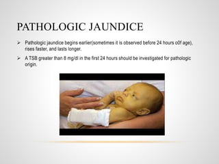 Neonatal jaundice | PPTX | Pregnancy | Reproductive Health