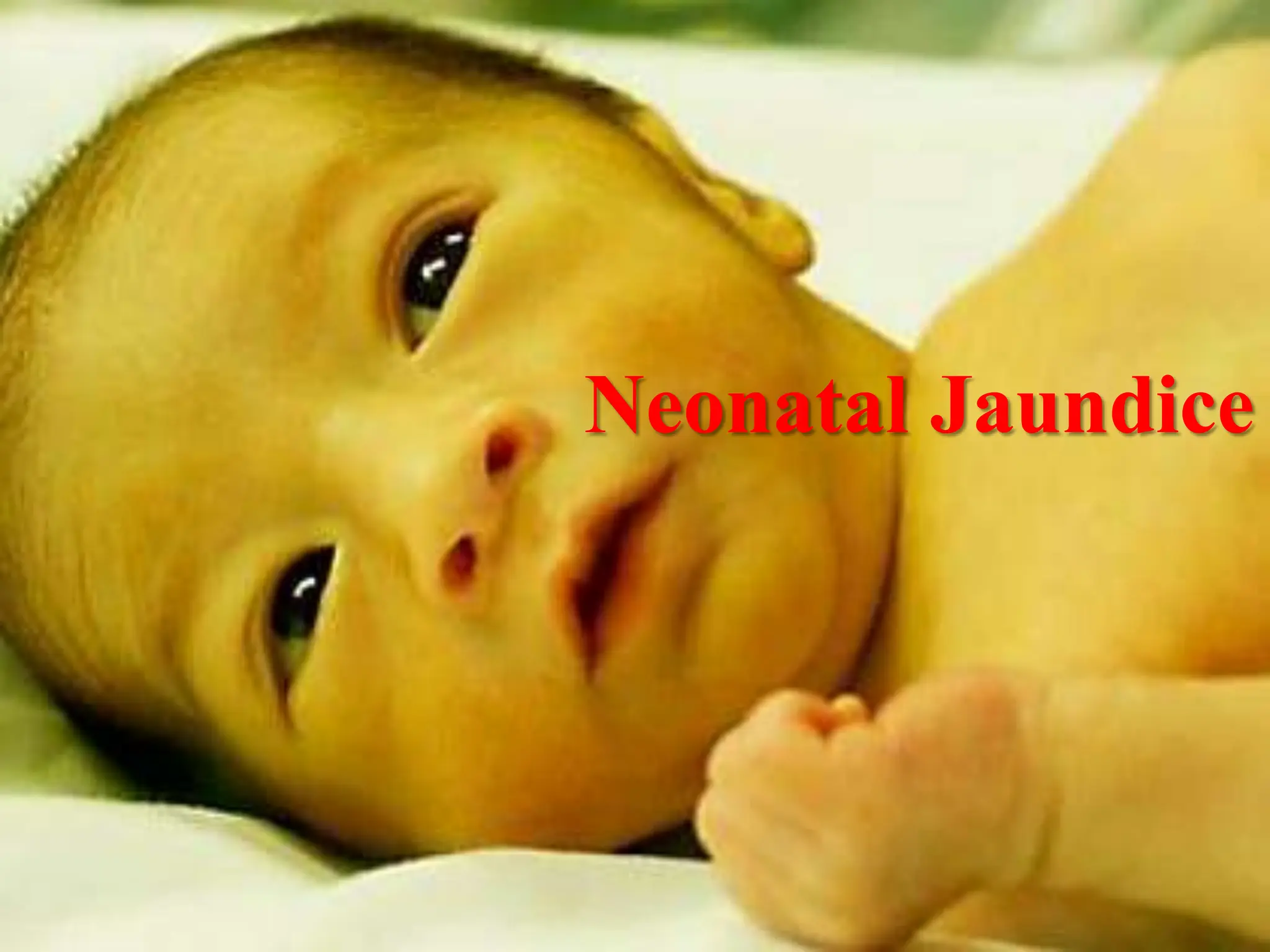 Neonatal Jaundice.pptx