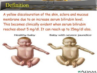 care baby with neonatal jaundicexxxx.ppt