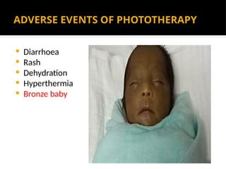 Neonatal Jaundice.pptx pediatrics presentation | PPT