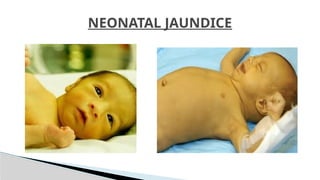 Neonatal Jaundice presentation paediatrics | PPTX