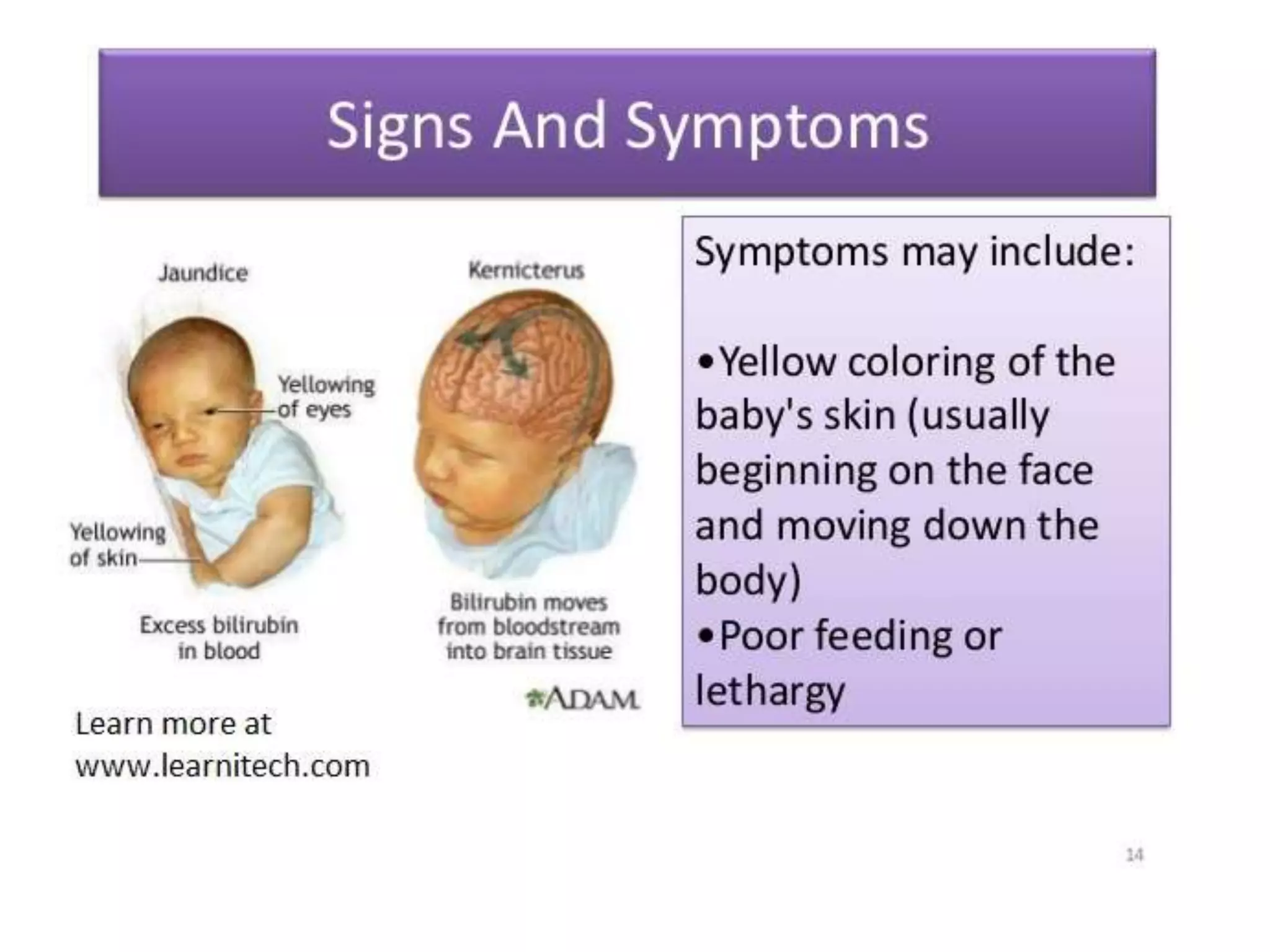 Neonatal jaundice - 2017 | PPTX